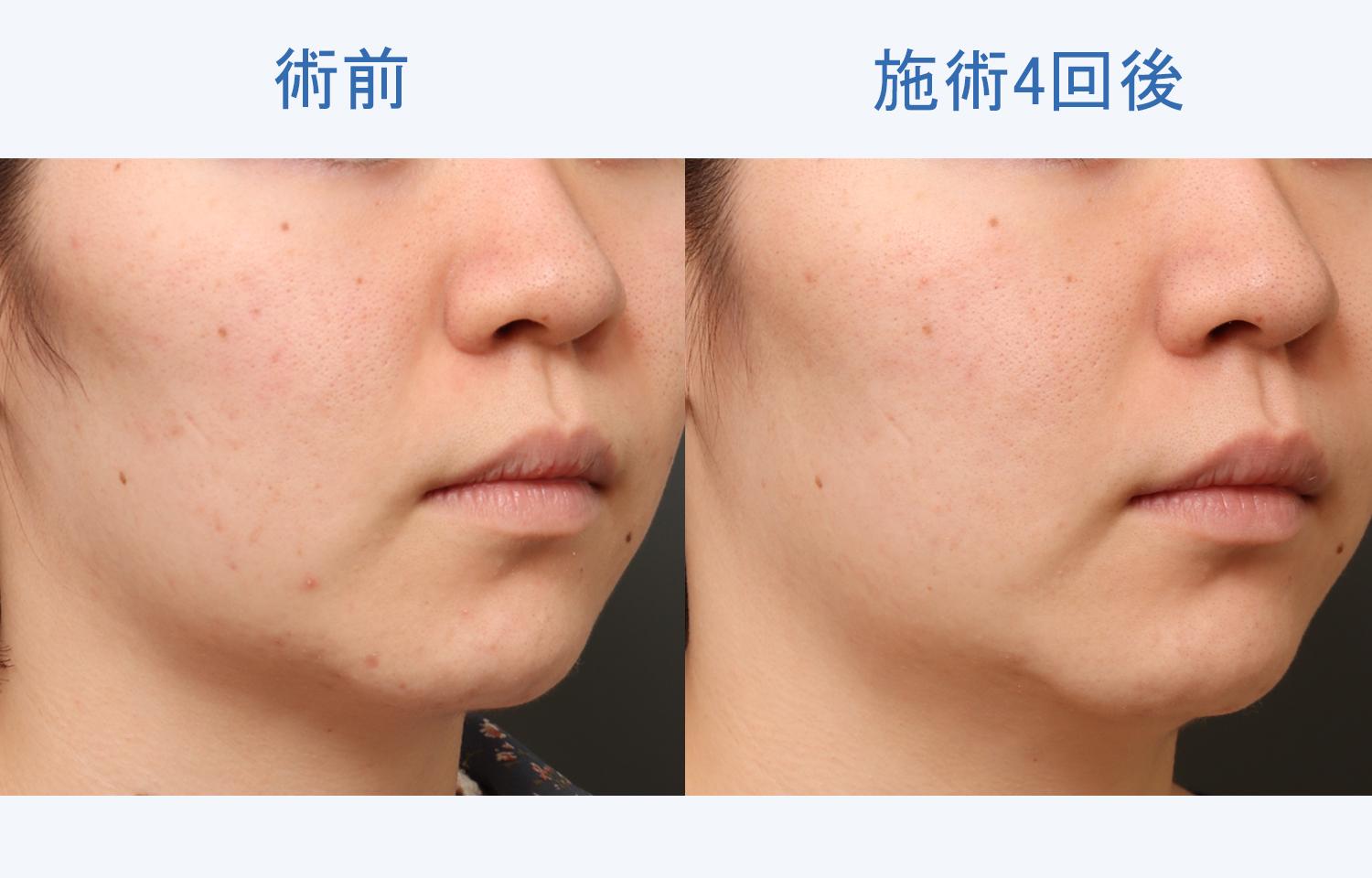 白ニキビを一掃！肌管理毛穴スリークスキン4回施術後の経過をご紹介！｜【公式】オザキクリニック（新宿・目黒祐天寺・羽村）