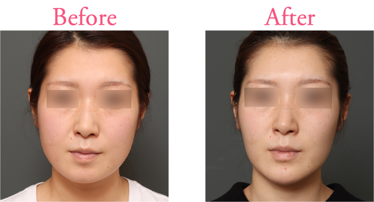 リバウンドのない顔やせで第一印象を変える｜【公式】オザキクリニック（新宿・目黒祐天寺・羽村）