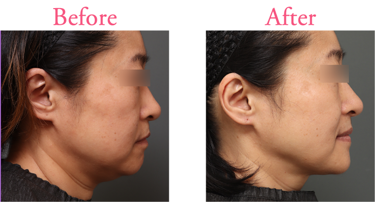 リバウンドのない顔やせで第一印象を変える｜【公式】オザキクリニック（新宿・目黒祐天寺・羽村）